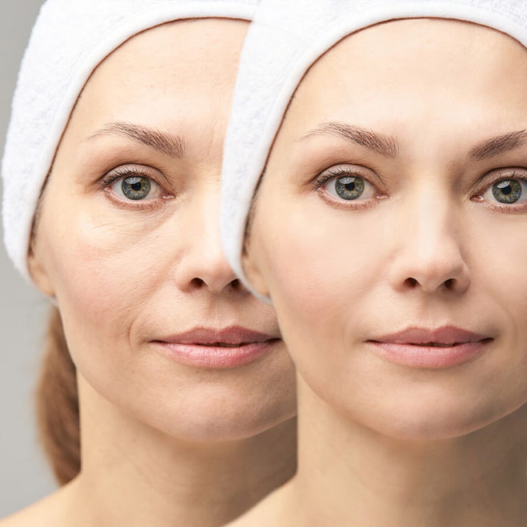 Improve Your Tired-Looking Eyes and Face!